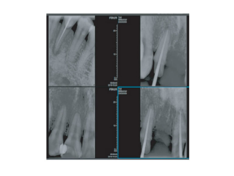 Sensor dental intraoral RVG Xpect Vision para radiografía digital